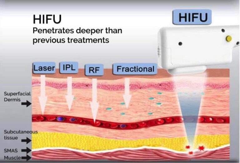 HIFU Facial Treatment | Collagen Stimulation - Luna Clinic