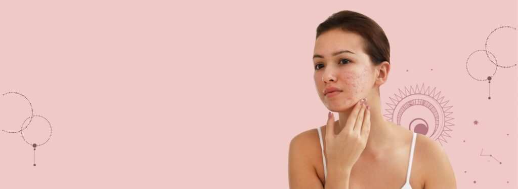 Acne Clinic Treatment | Luna Clinic KL