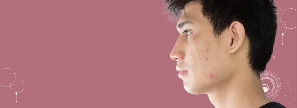 Open Pore Treatment | Luna Clinic KL