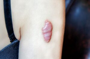 Atrophic vs Hypertrophic & Keloid Scars | Luna Clinic