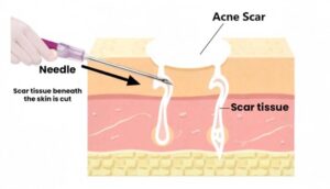 What is Subcision for Acne Scars? | Luna Clinic