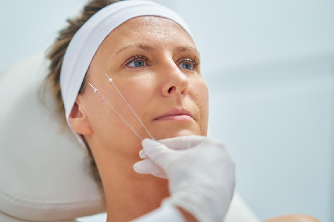 Is Thread Lift Safe? Areas You Can Treat with Thread Lift | Luna Clinic