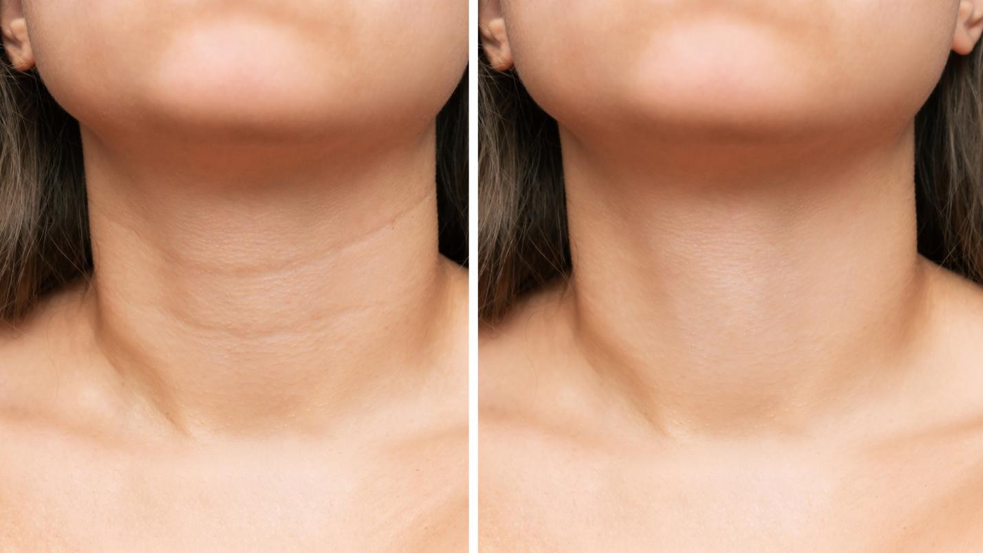Stages of Neck Aging & How to Treat It | Luna Clinic